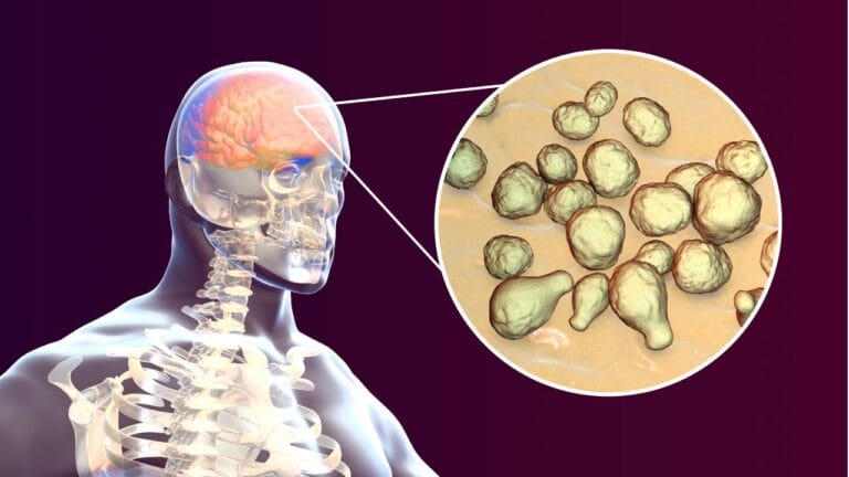 6 Jenis Meningitis dan Cara Mencegahnya | Tirta Medical Centre Medical
