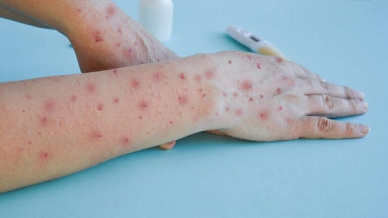 Cacar Monyet (Monkeypox): Gejala, Penyebab, & Pengobatan